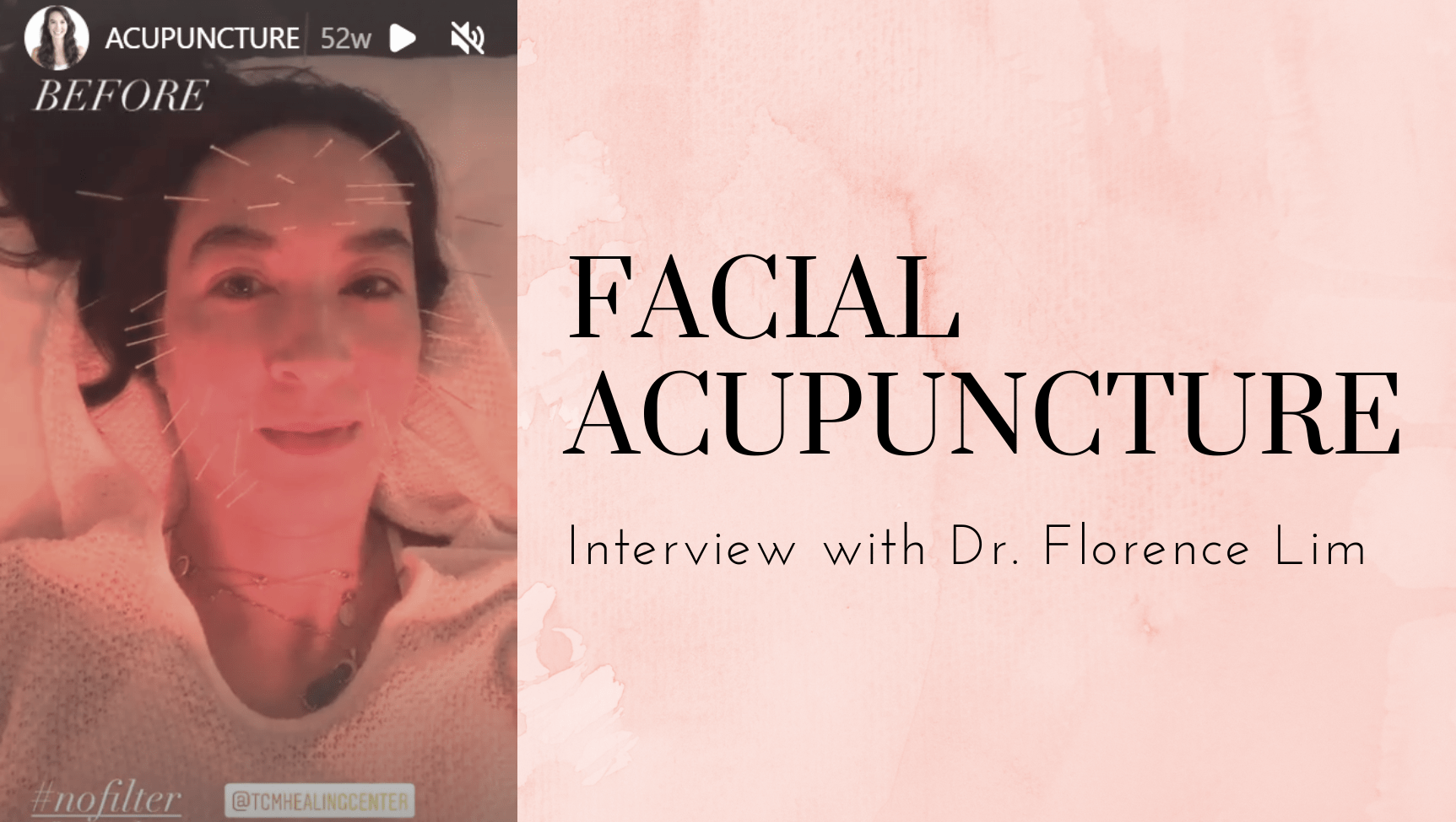 Facial Acupuncture